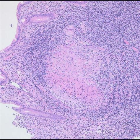 Colonoscopy Demonstrated Mild Erythema And Punctate Ulcerations In The