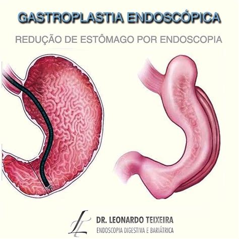 Dr. Leonardo Teixeira - Gastroplastia endoscópica é um procedimento indicado para paciente com ...