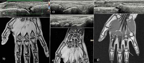 Female 32 Years Old 3rd Mcp Joint A Longitudinal Ultrasound With Download Scientific