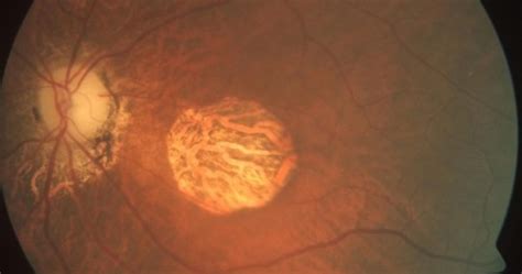 Understanding Geographic Atrophy Causes Symptoms Treatment And Prevention