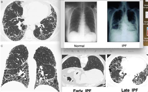 Interstitial Lung Disease Flashcards Quizlet