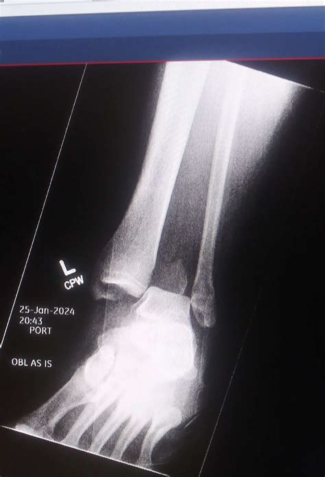Bro Shredded His Distal Tibiofibular Joint Yikes R Anatomy