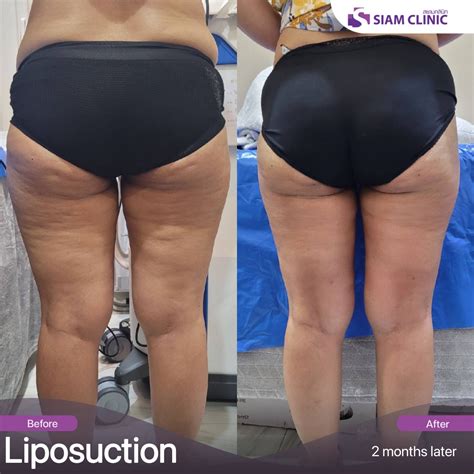 Liposuction Before And After Photos Siam Clinic Thailand