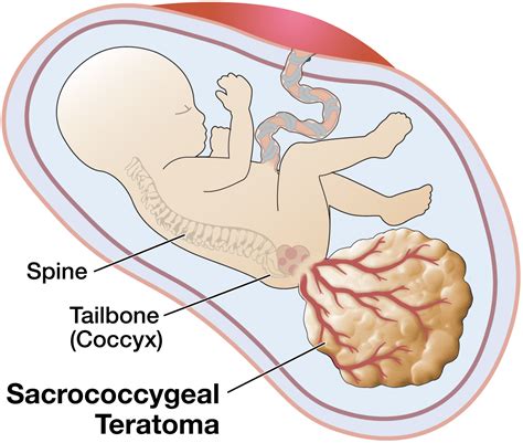 What Is Sacrococcygeal Teratoma Mxqd