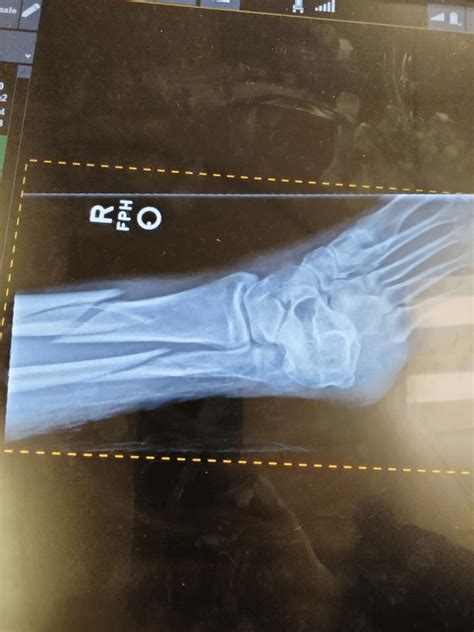 Broke Both My Tibia And Fibula R Brokenbones