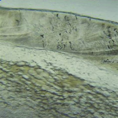 Photomicrograph Showing Increased Interglobular Dentin Download Scientific Diagram
