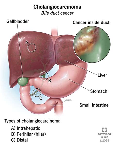 Cholangitis Meaning Bile Duct Diseases Harvard Health