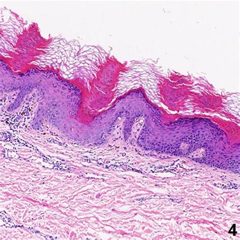 Epidermal Hyperkeratosis And Parakeratosis With Cornoid Lamellae In The
