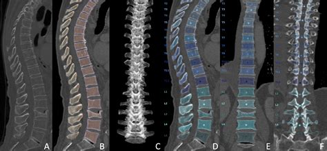 Deep Learning To Differentiate Benign And Malignant Vertebral Fractures At Multidetector Ct