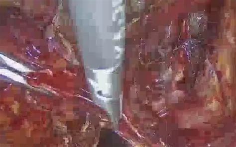 Laparoscopic Reverse Technique In Excision Surgery For Deep