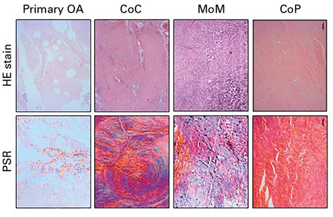Ceramic Prosthesis Surfaces Induce An Inflammatory Cell Response And