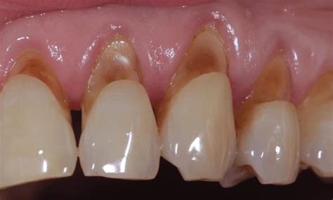Erosion Teeth