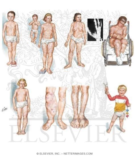 Limb Length Discrepancy