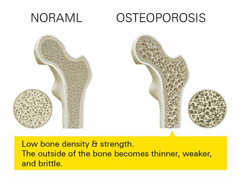 Osteoporosis Bone Comparison