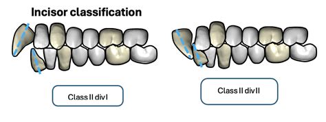 Managing Class Ii Malocclusion With Invisalign Dentistry