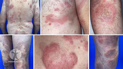 Dermnet Case 65 Year Old With A Widespread Polymorphous Rash