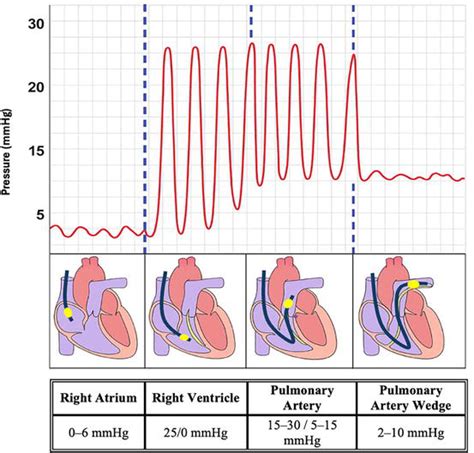 Pulmonary Artery Catheter The Golden Way Of Advanced Hemodynamic