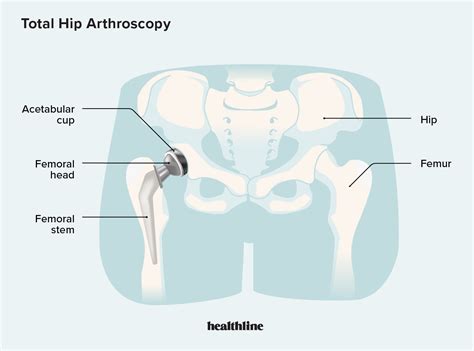 What To Know About A Total Hip Arthroplasty Procedure Recovery More
