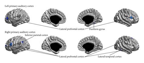 Negative Modulations Of Structural Covariance Networks By Sleep
