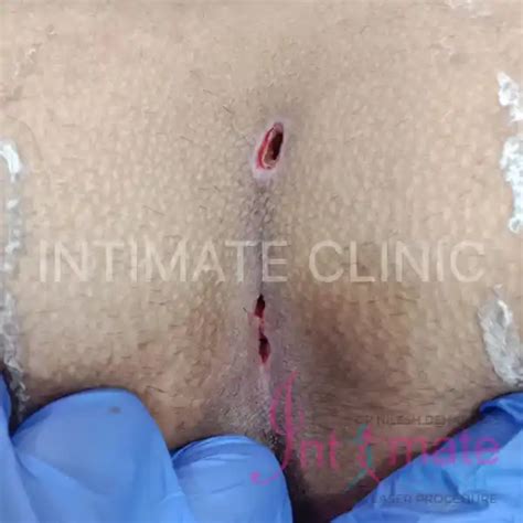 Excision Of Pilonidal Sinus And Ablation In Indore Dr Nilesh Dehariya