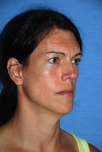 Transgender Surgery Before And After Photos Seattle Bellevue