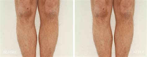 Super Inductive System Muscle Atrophy Isomatic Integrative Health Centre