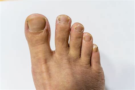 가려운 발 혹시 무좀 증상부터 치료까지 꼼꼼히 알아보는 무좀 관리법 닥터나우