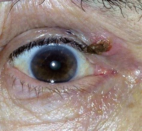 Actinic Keratosis Horn Like