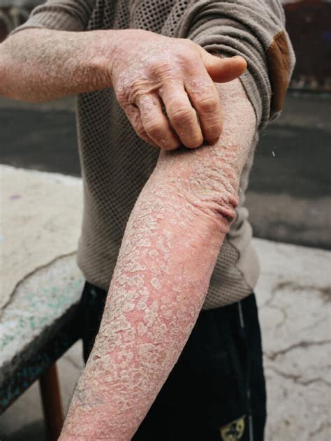 In Search Of Relief For Itch Due To Prurigo Nodularis Revival