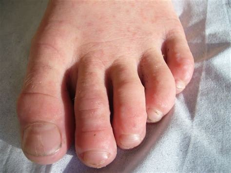 Hand Fuß Mund Krankheit Deximed Deutsche Experteninformation Medizin