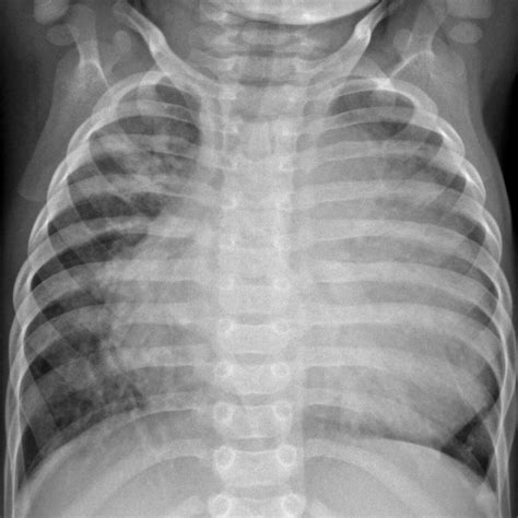 Pneumonia Multi Class Kaggle