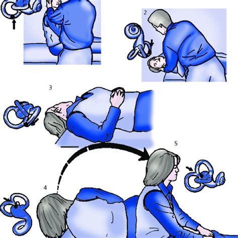 3 Canalith Repositioning Maneuver Step 1 Seat The Patient On A Table