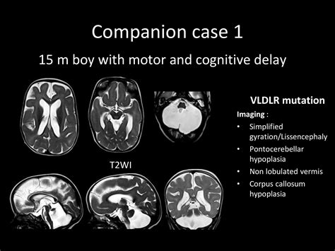 3 Year Old Female With Microcephaly Developmental Delay Dyskinesia Truncal Hypotonia Facial