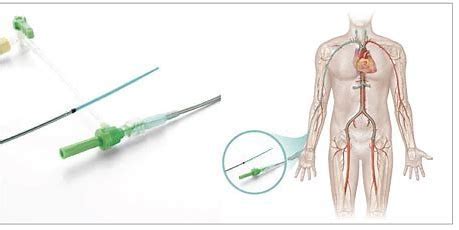Terumo Launches R2p™ Navicross® Catheter In The U S Enhancing Radial
