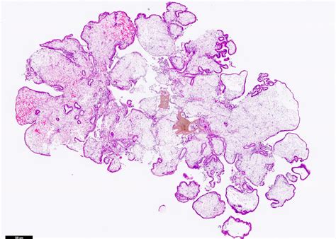 Pathology Outlines Cholesterol Polyp