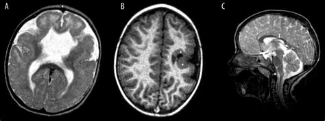 Diagnostic Imaging And Problems Of Schizencephaly Pmc