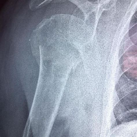 Fractura Subcapital Dr Jose Mario Dorantes Rodríguez Ortopedista Y