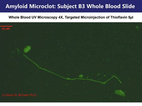 Breaking Prion Like Amyloid Fibrils Found In 3 Year Old Born Lifeless