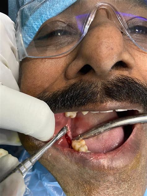 Painless Tooth Extraction In Varanasi Oro Dental Clinic Varanasi