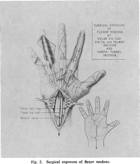Figure 2 From Surgical Exposure Of Flexor Tendons In The Hand