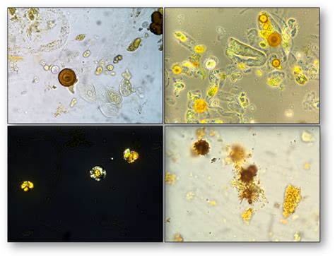 Urine Sediment Of The Month Findings In Cirrhosis Cholestasis And Hyperbilirubinuria Renal