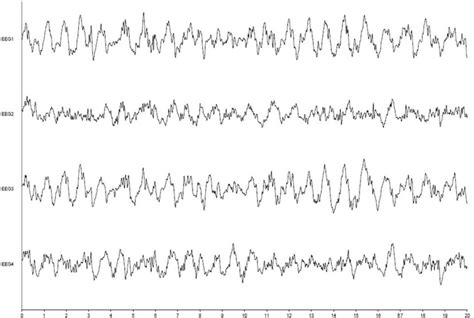 Pattern Of Polyspike Ps Type Eeg Recording Eeg 1 Fp1 Left Mastoid Download Scientific