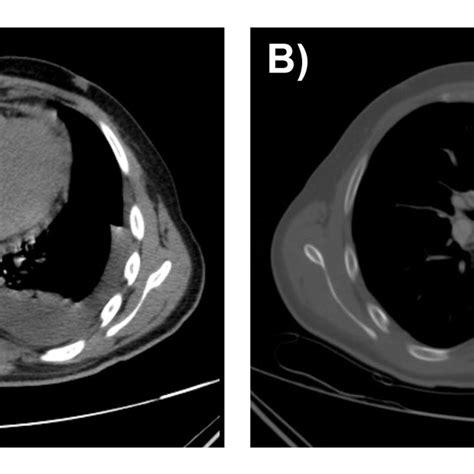 Chest Computed Tomography Ct Scan On Day 24 After Admission Showing