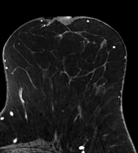 Diffusion Weighted Mri Association Between Patient Characteristics And