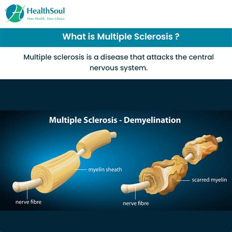 Multiple Sclerosis Symptoms Multiple Sclerosis Clinics Krctv
