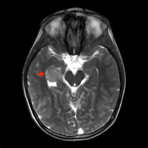 Plexus Tumor Neurosurgery Inselspital Bern