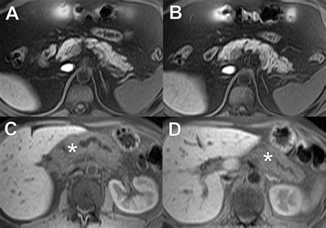 Mr Imaging Of The Pancreas A Pictorial Tour Radiographics