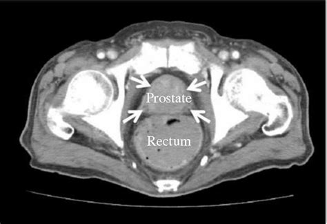 Figure 8 From Impact Of Intrafractional Prostate Motion On The Accuracy And Efficiency Of