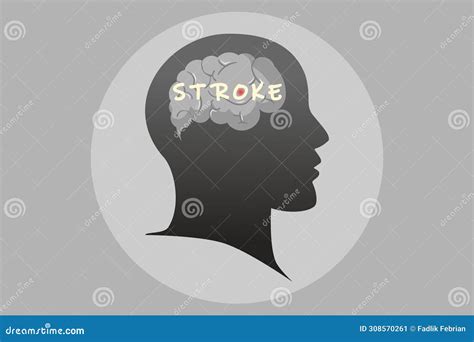Stroke Disease Concept Ischemic And Hemorrhagic Scientific Medical
