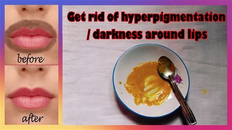 Get Rid Of Hyperpigmentation Around Lips Darkness Around Lips Youtube